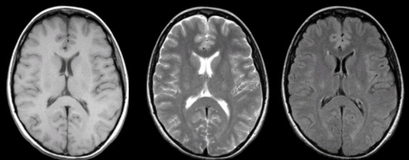 L uso Delle Immagini Di Risonanza Magnetica Nello Studio Dell Alzheimer