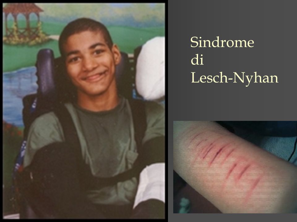 Sindrome De Lesch Nyhan - LIBRAIN