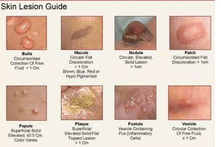 Guida alle lesioni cutanee: imaging e nomenclatura | Nurse Times