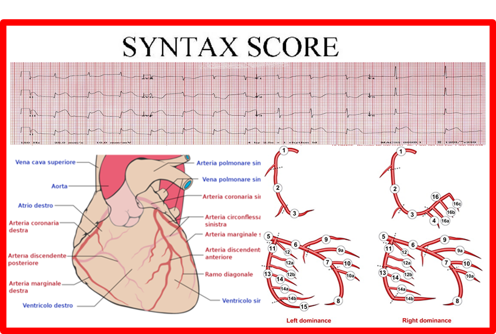 Syntax Score: indice di anatomia coronarica | Nurse Times