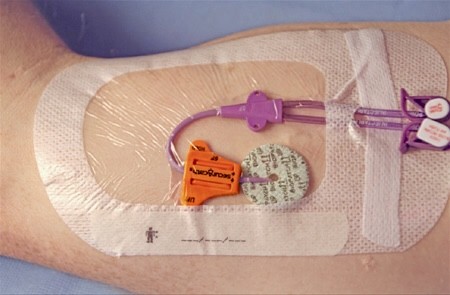 SecurAcath, il sistema di fissaggio universale per cateteri venosi e ...